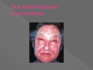 Inflammatory myositis | PPT