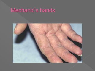 Inflammatory myositis | PPT