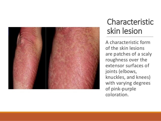 Myositis Skin Rash