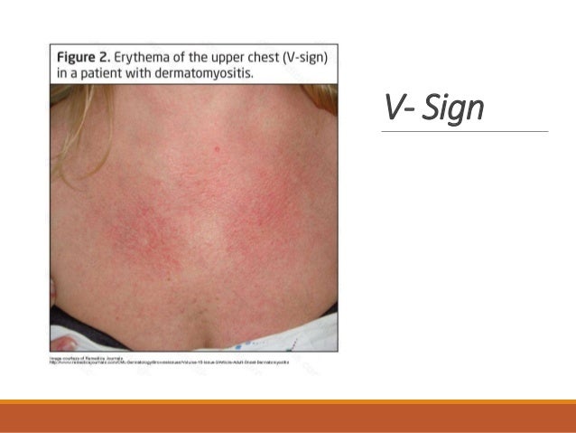 Myositis Skin Rash