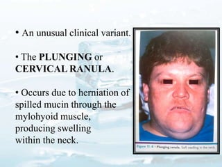 Inflammatory pappilary hyperplasia & ranula | PPTX