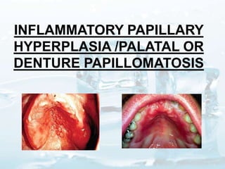 Inflammatory pappilary hyperplasia & ranula | PPTX