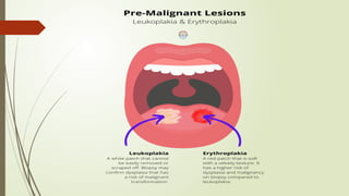 INFLAMMATORY & ULCERATIVE LESIONS OF ORAL CAVITY SGD.pptx