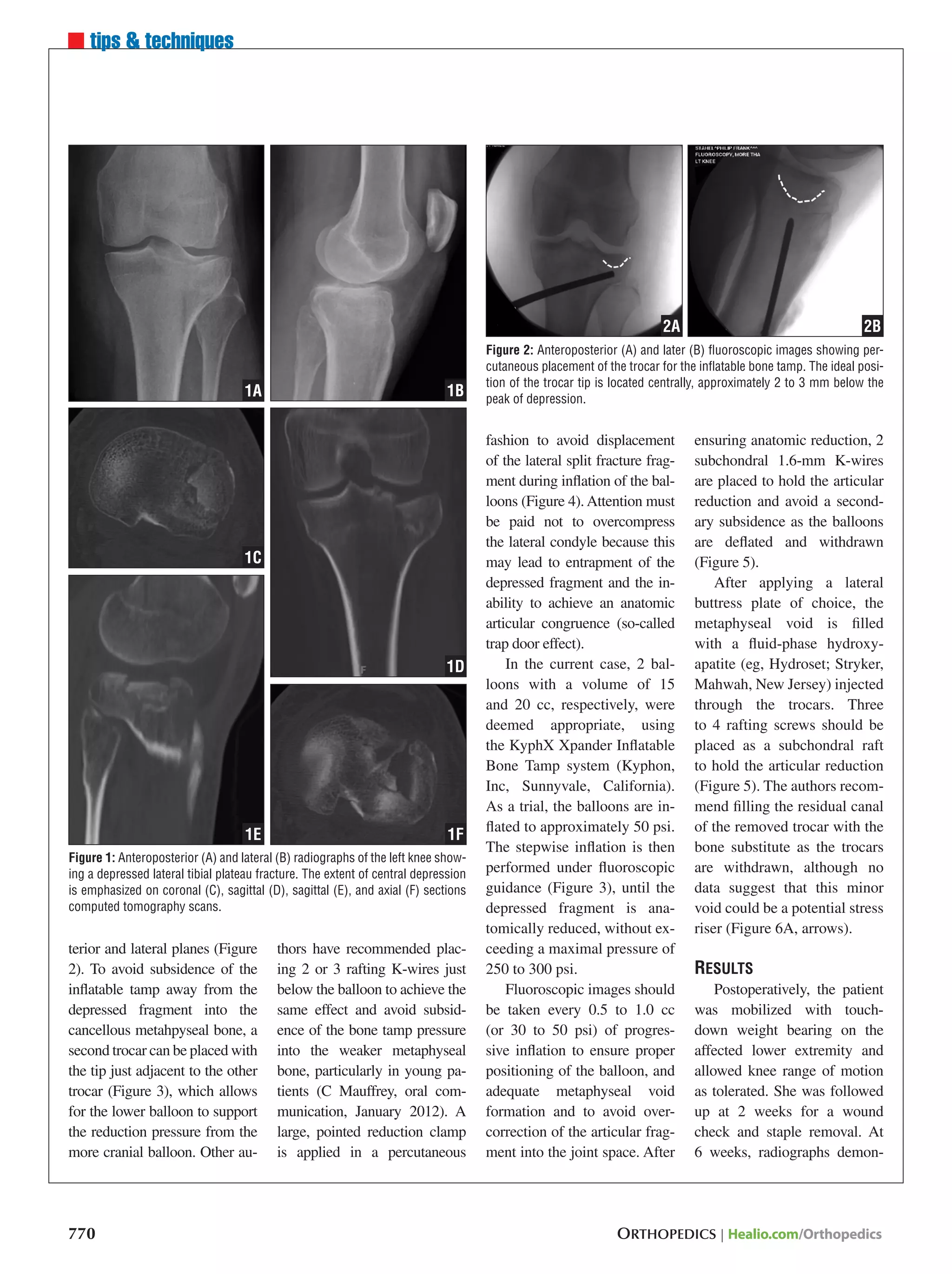 Inflation osteoplasty | PDF