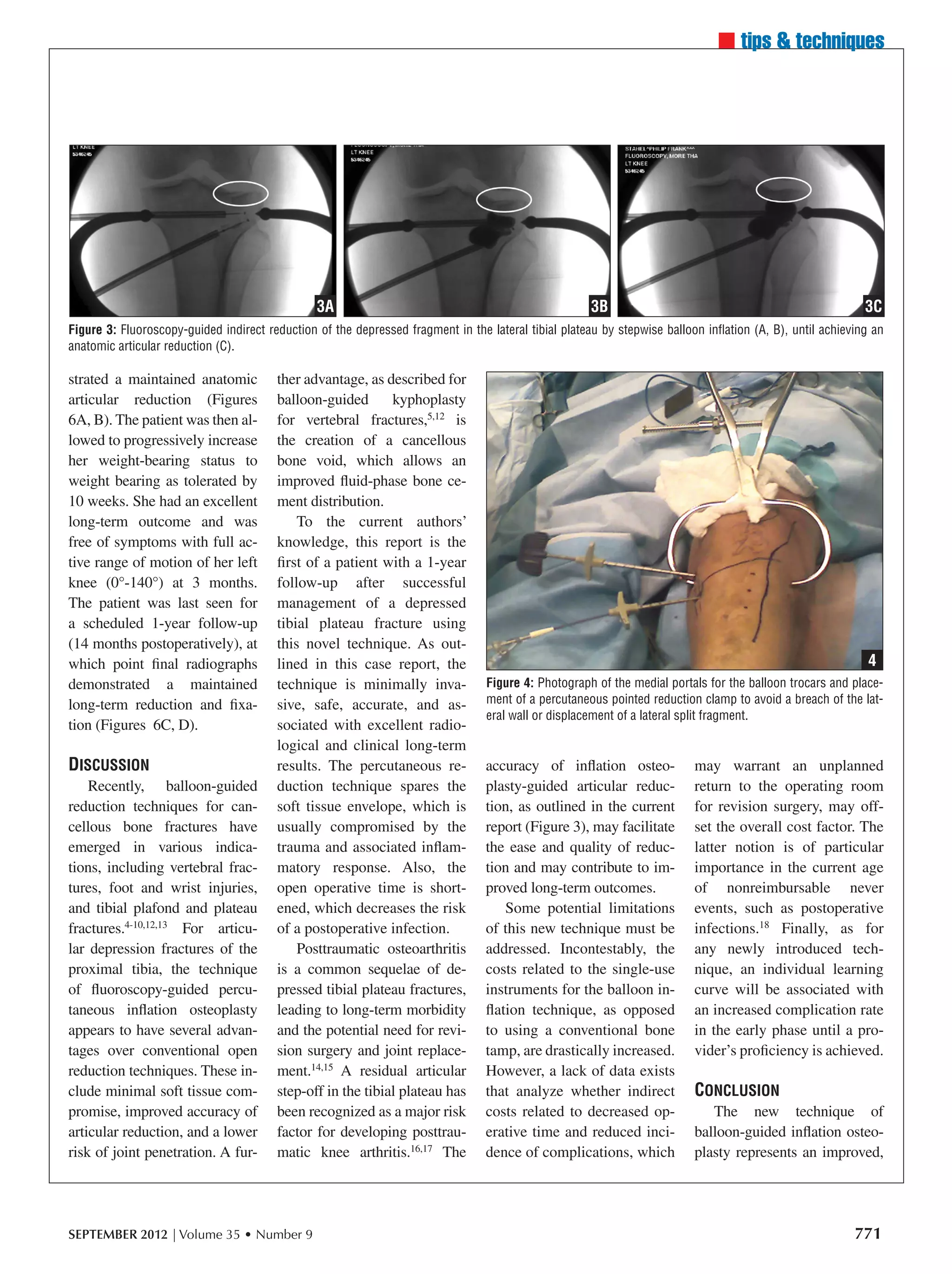 Inflation osteoplasty | PDF