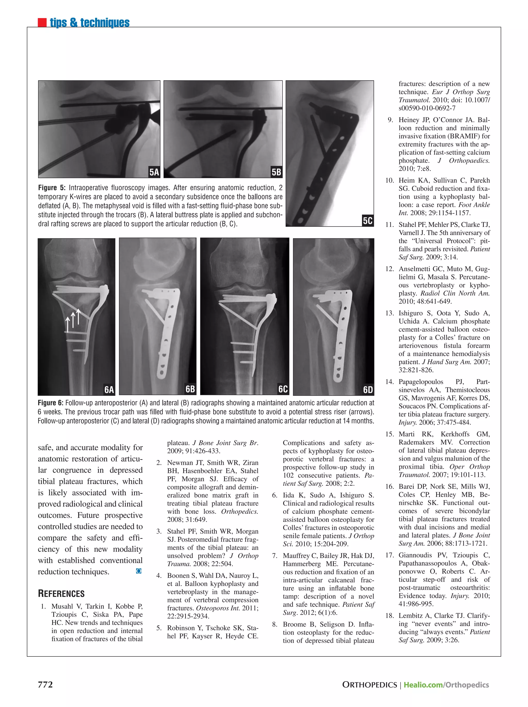 Inflation osteoplasty | PDF