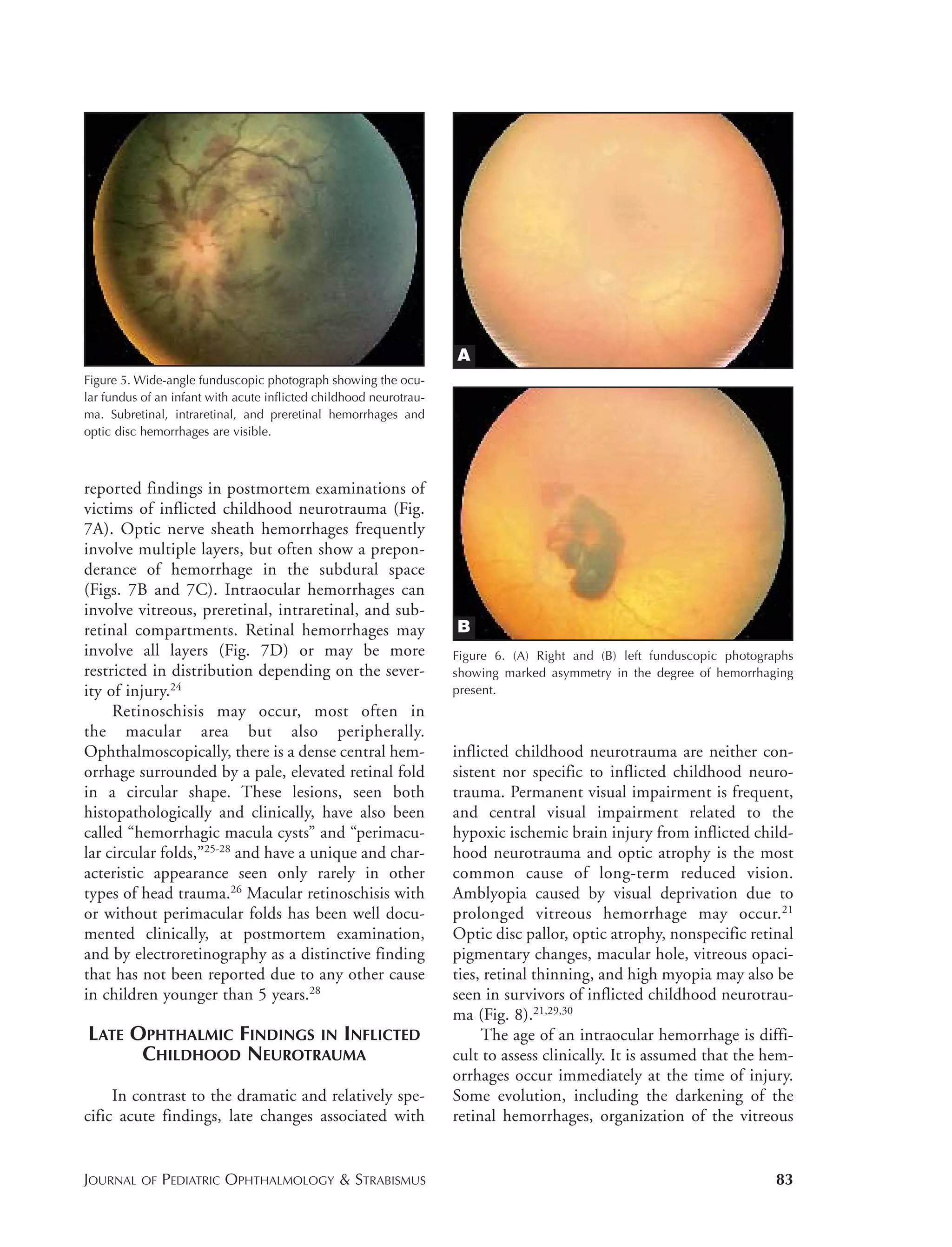 Inflicted childhood neurotrauma (shaken baby syndrome) ophthalmic ...