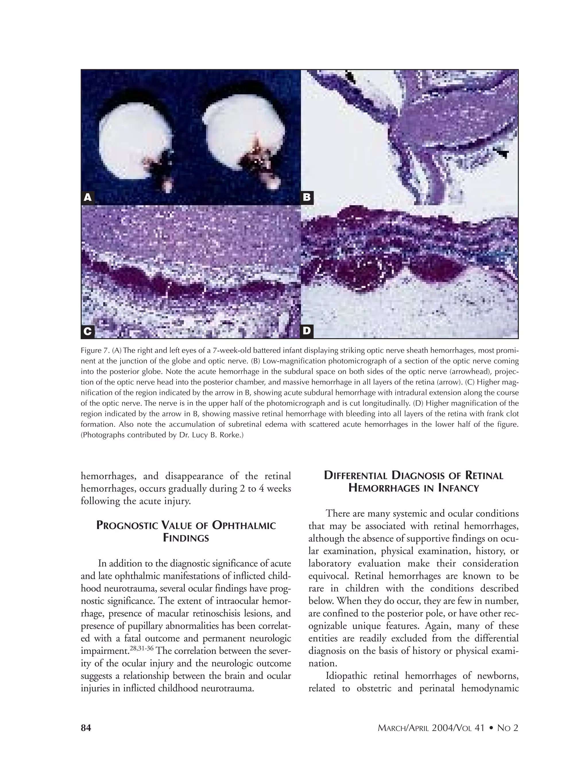 Inflicted childhood neurotrauma (shaken baby syndrome) ophthalmic findings | PDF | Death, Injury ...