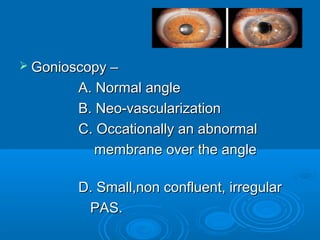 Inflm. glaucoma | PPT