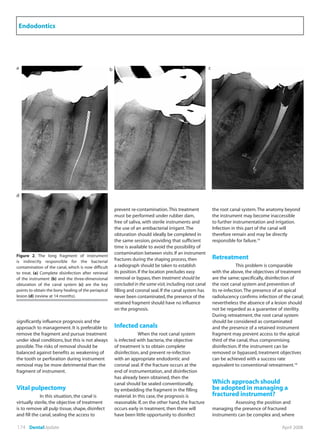 Influence of fractured instruments on the success rate of endodontic ...