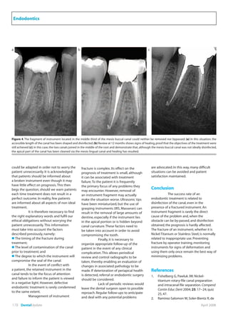 Influence of fractured instruments on the success rate of endodontic ...