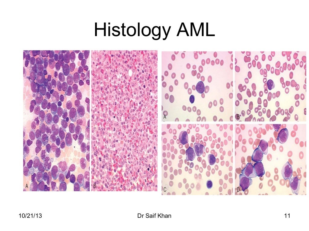 Influence Of Hematological Disorder On Periodontium