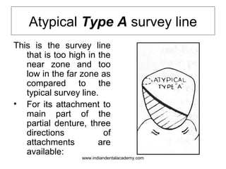 Influence of survey line on designing of clasp / dental implant courses ...