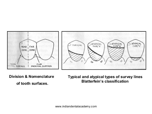 Influence of survey line on designing of clasp / dental implant cours…