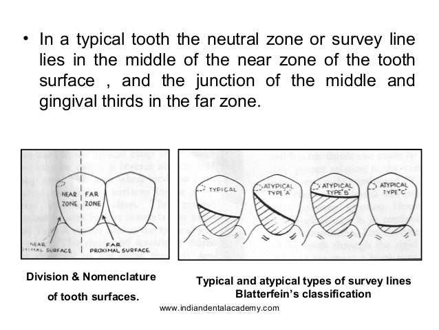 Influence of survey line on designing of clasp / dental implant cours…