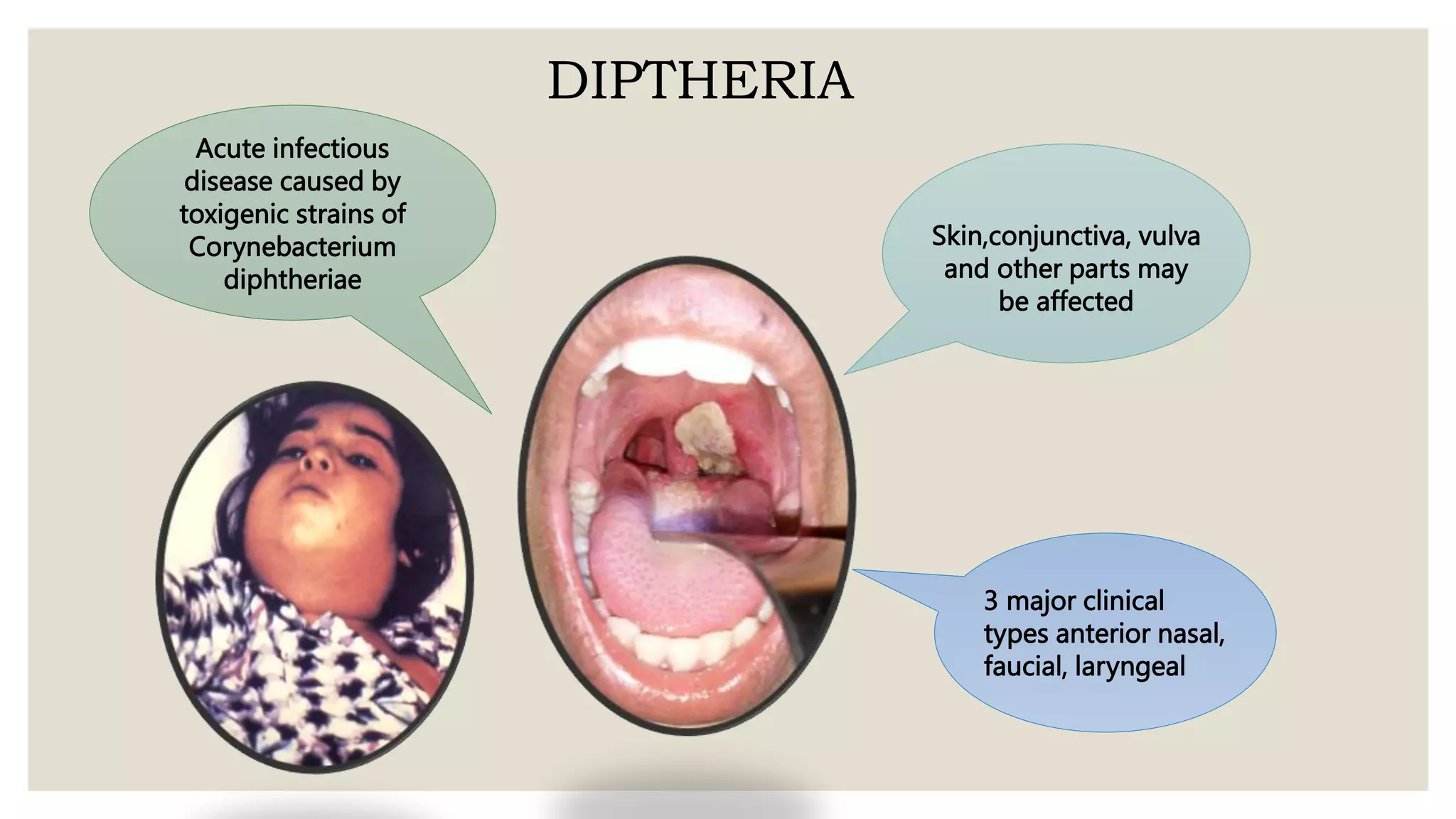 influeza and diptheria -Dr Krishna Smirthi CV.pptx