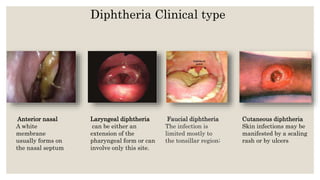 influeza and diptheria -Dr Krishna Smirthi CV.pptx