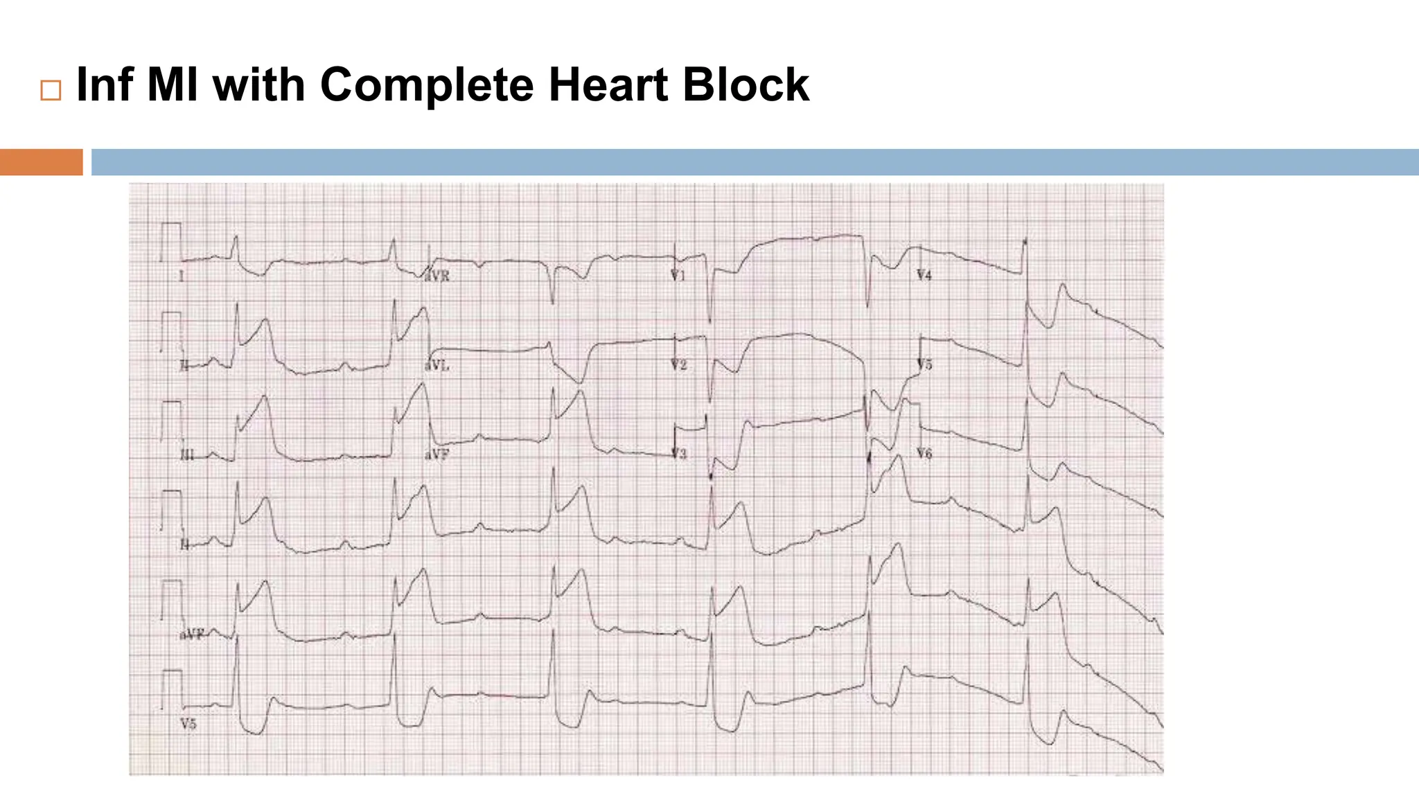 Inf MI with RVMI by Dr. Jahangir Alam (1).pptx