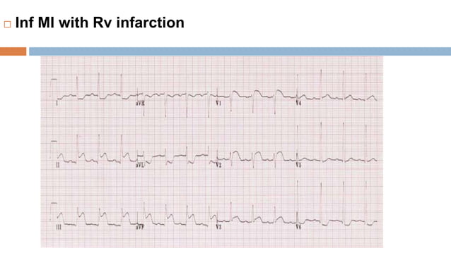 Inf MI with RVMI by Dr. Jahangir Alam (1).pptx