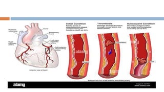 Inf MI with RVMI by Dr. Jahangir Alam (1).pptx