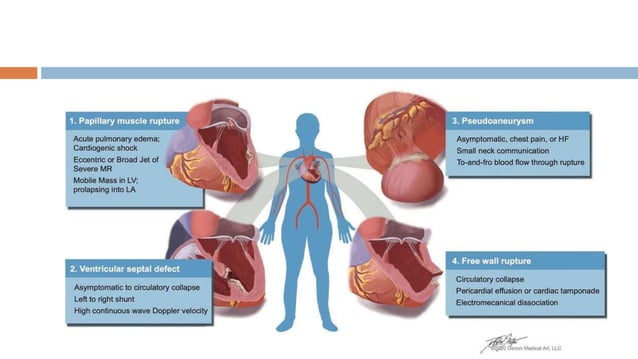 Inf MI with RVMI by Dr. Jahangir Alam (1).pptx