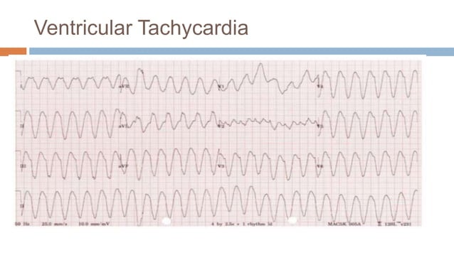 Inf MI with RVMI by Dr. Jahangir Alam (1).pptx