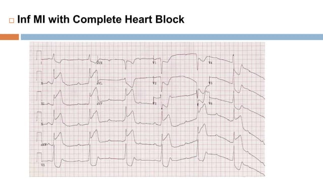 Inf MI with RVMI by Dr. Jahangir Alam (1).pptx