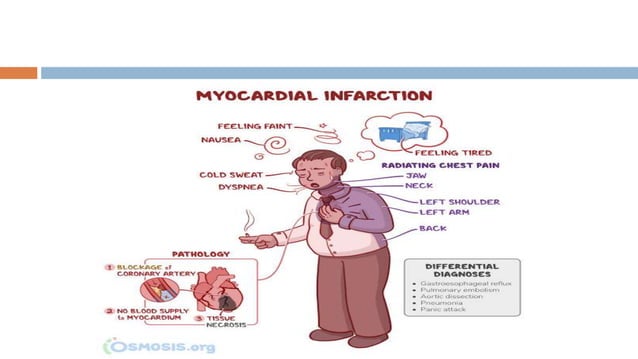 Inf MI with RVMI by Dr. Jahangir Alam (1).pptx