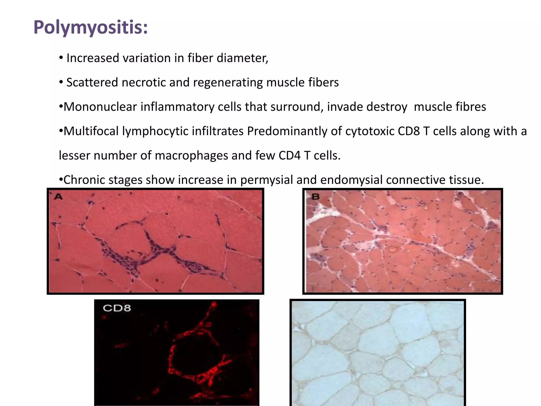 Inflammatory Myopathies | PPTX