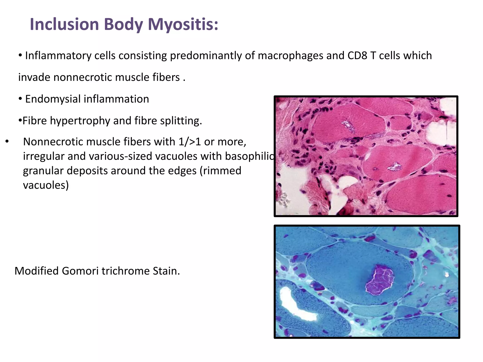 Inflammatory Myopathies | PPTX | Physical Therapy | Wellness