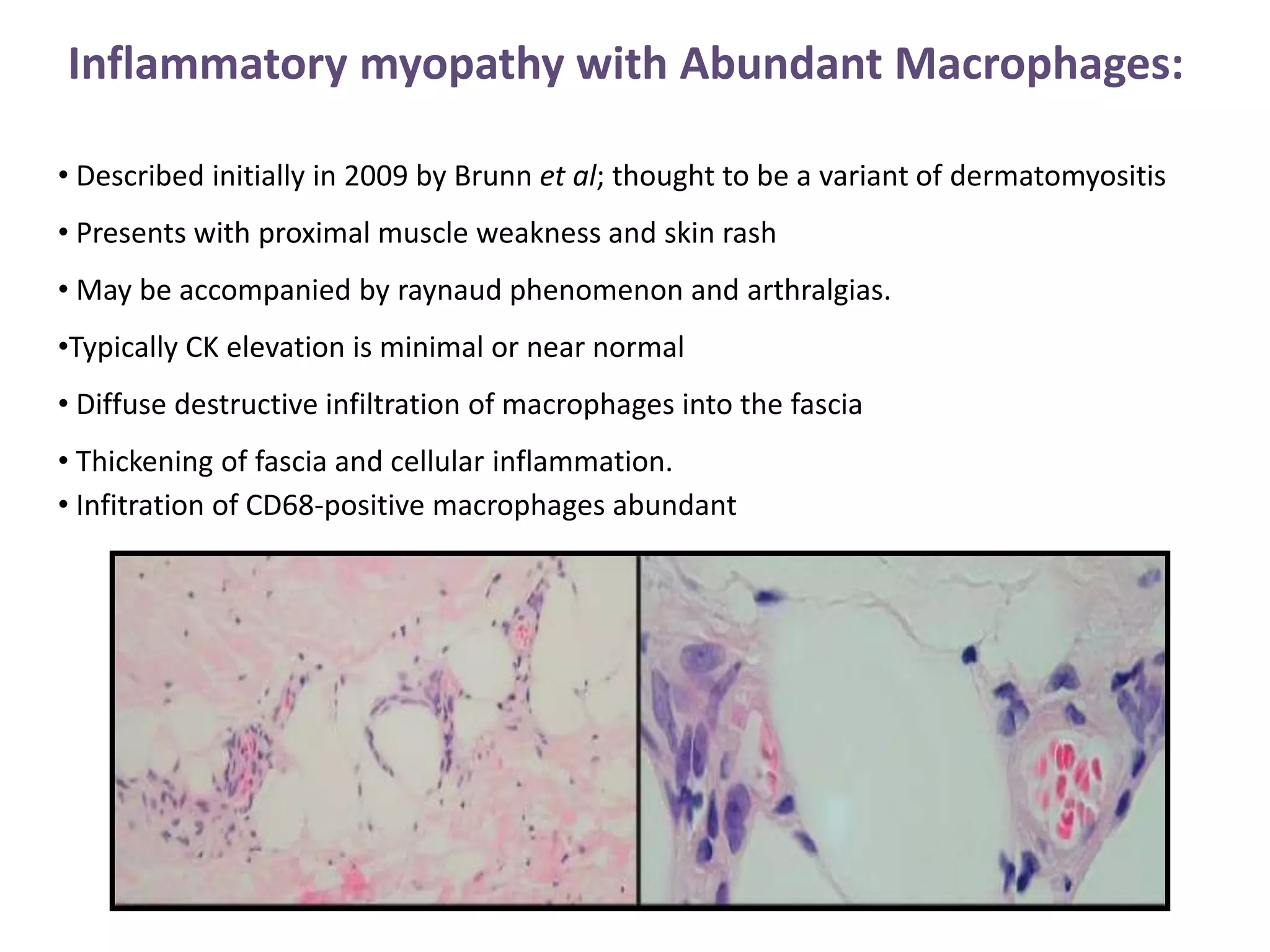 Inflammatory Myopathies | PPTX