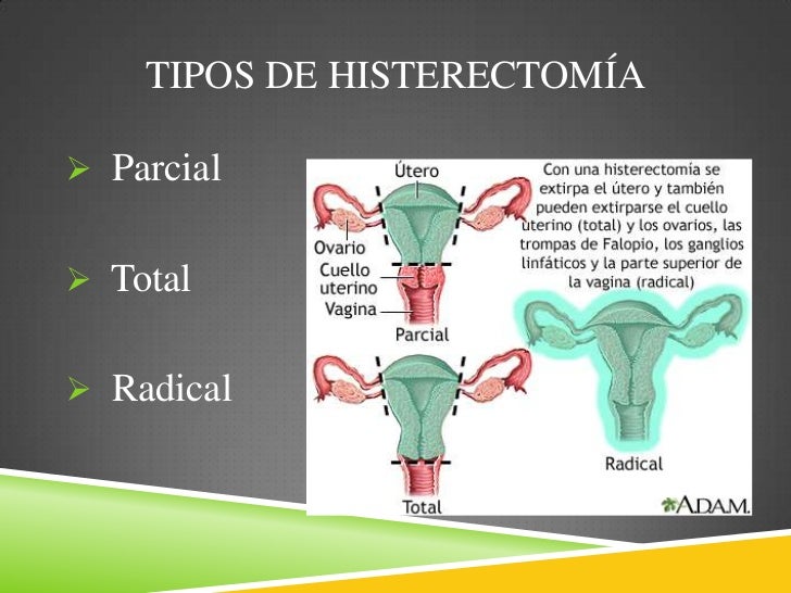 Informe oral histerectomía