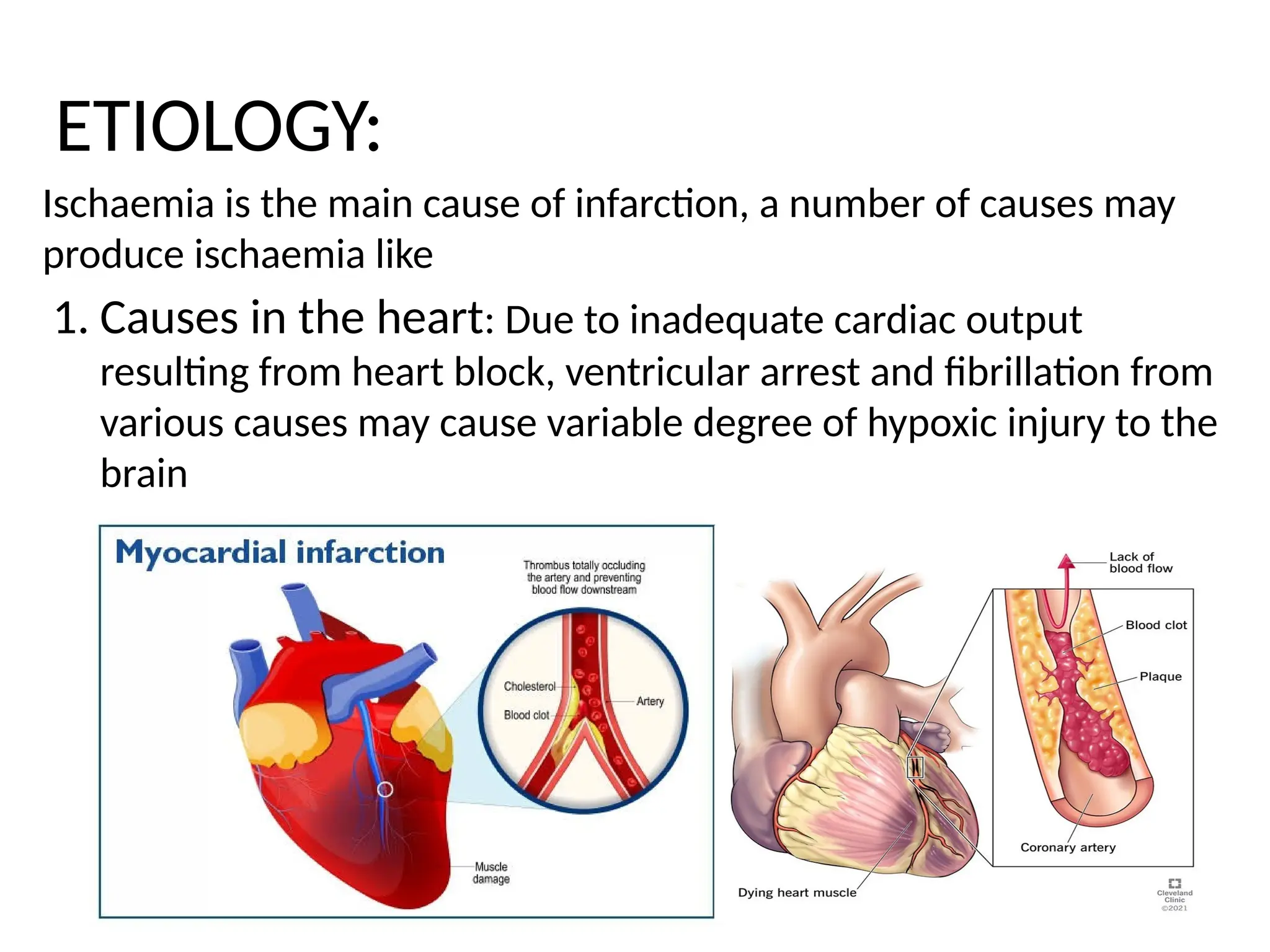 infraction ppt pathology for practical.pptx | Heart and Cardiovascular ...