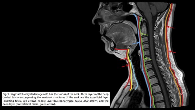 Imaging of the Infrahyoid neck spaces.pdf