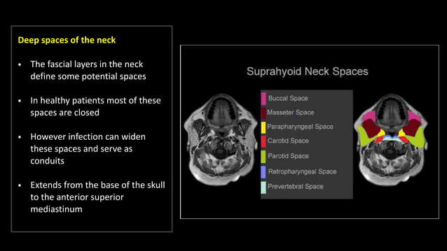 Imaging of the Infrahyoid neck spaces.pdf