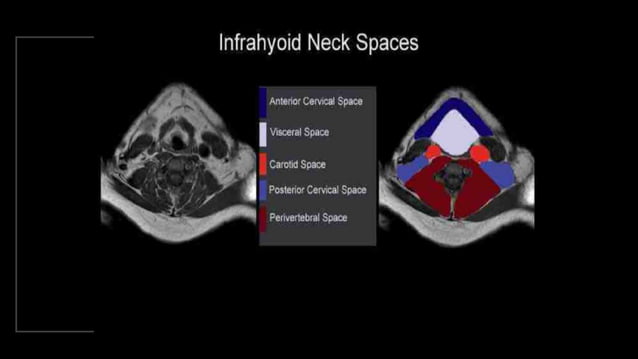 Imaging of the Infrahyoid neck spaces.pdf