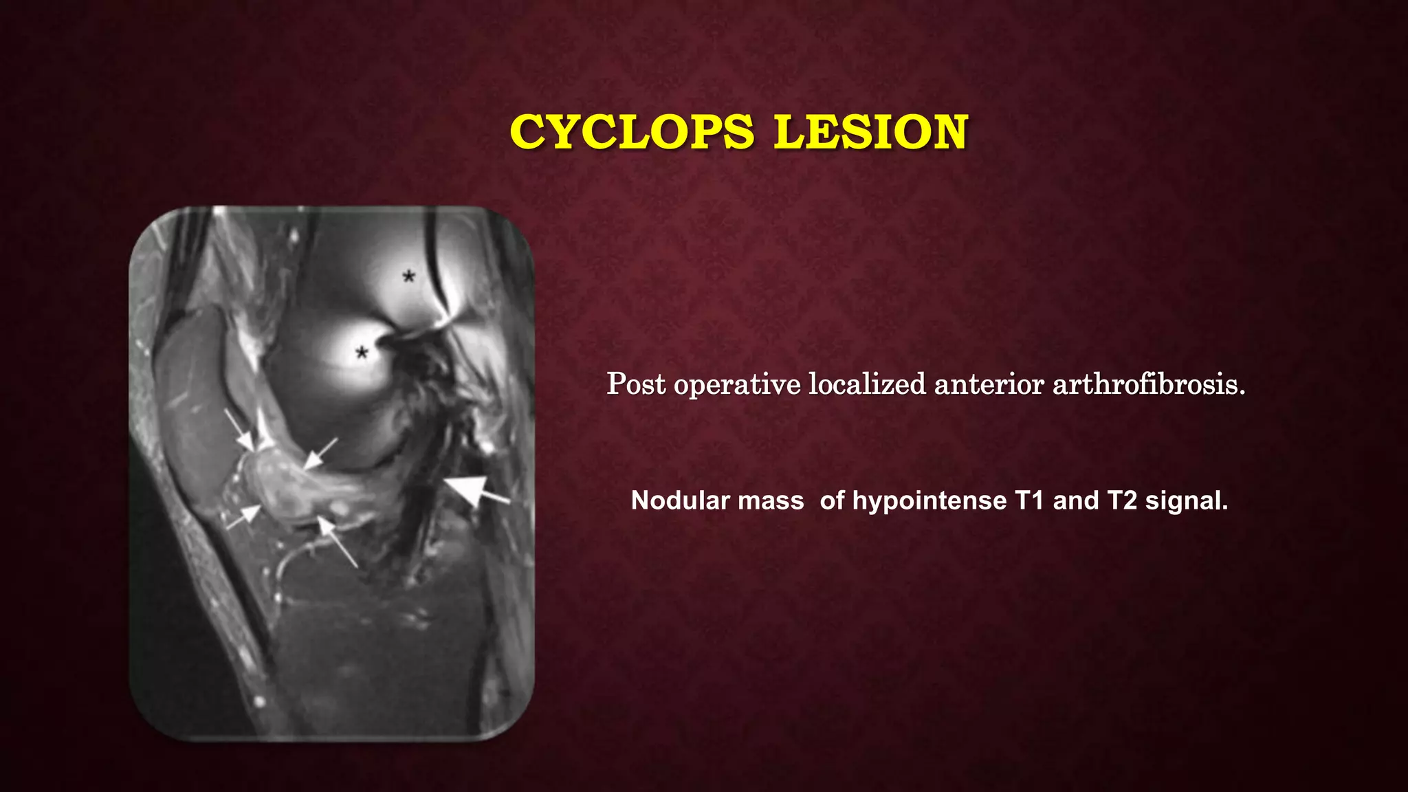 Infrapatellar fat pad abnormalities | PPTX