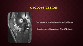 Infrapatellar fat pad abnormalities | PPTX