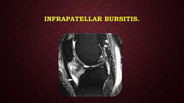 Infrapatellar fat pad abnormalities | PPTX