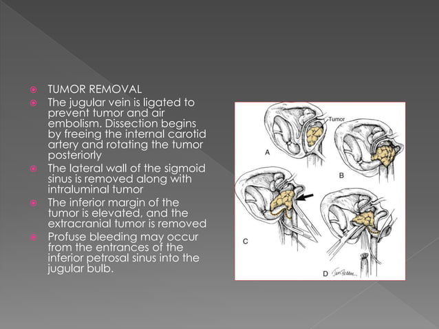 Infratemporal fossa approaches | PPTX
