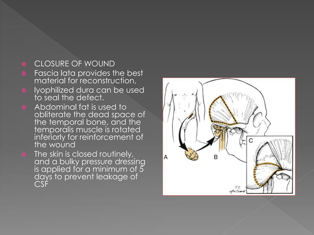 Infratemporal fossa approaches | PPTX