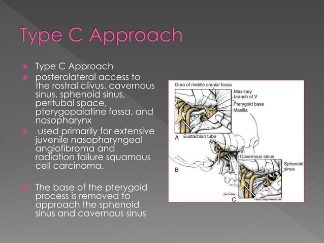 Infratemporal fossa approaches | PPTX