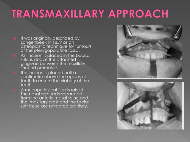 Infratemporal fossa approaches | PPTX