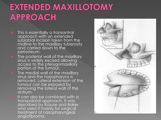 Infratemporal fossa approaches | PPTX