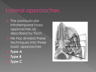Infratemporal fossa approaches | PPTX