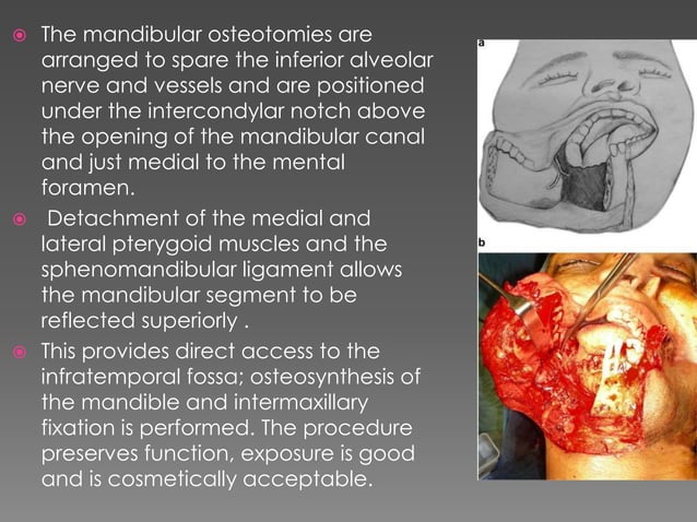 Infratemporal fossa approaches | PPTX
