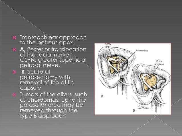 Infratemporal fossa approaches