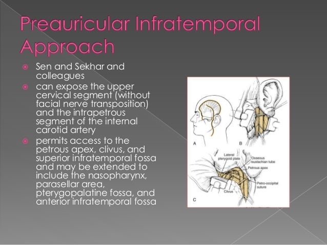 Infratemporal fossa approaches