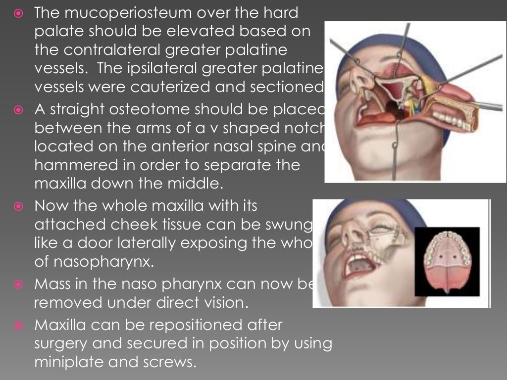 Infratemporal fossa approaches