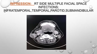 Infratemporal space infection | PPTX